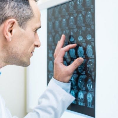 Speech Therapy After Stroke: How It Works & What to Expect