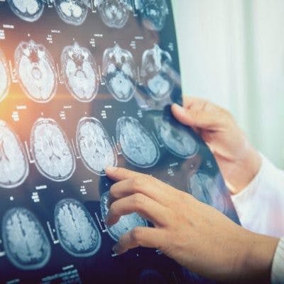 Internal Capsule Stroke: Symptoms & Recovery Process