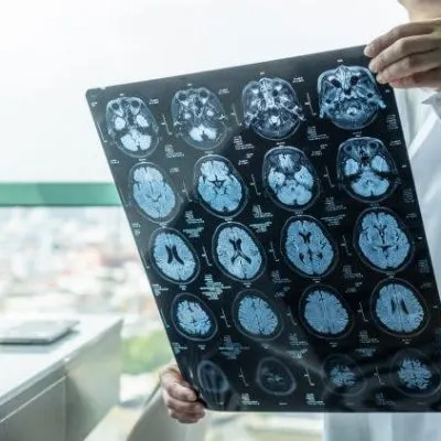 Cerebellum Brain Damage: Causes, Effects, and Rehabilitation